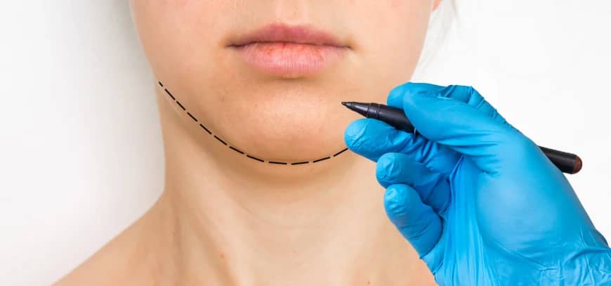 Chin Surgery – Op.Dr.Süphan Tunç